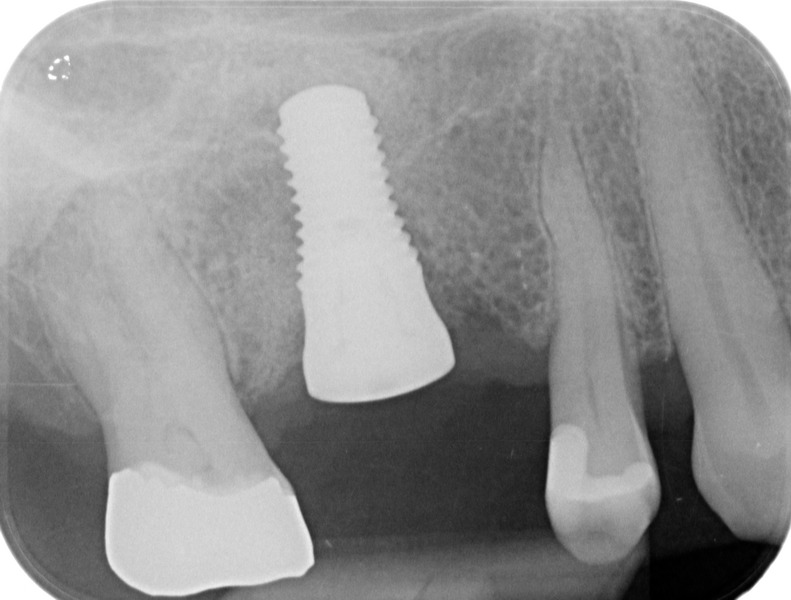 Benex Dent :: Large ridge defect after invasive extraction