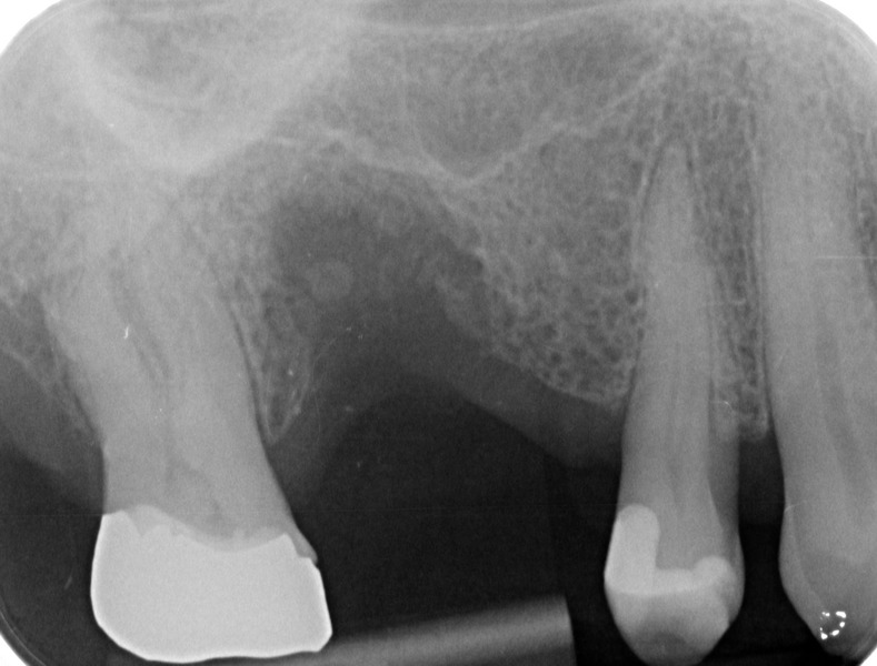 Benex Dent :: Large ridge defect after invasive extraction