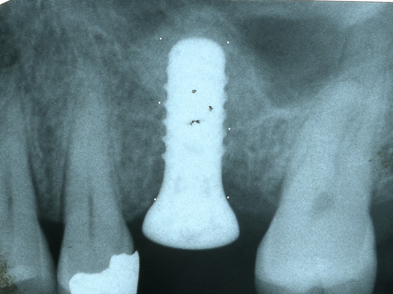 Augmentation remodeling