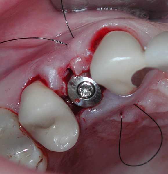 Transmucosal healing, suture technique