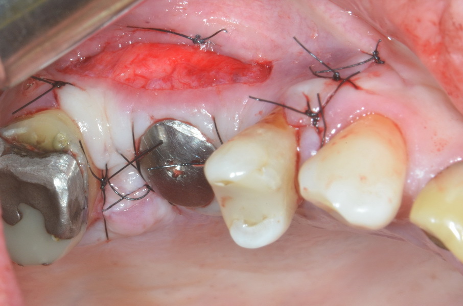 Benex Dent :: Large ridge defect after invasive extraction